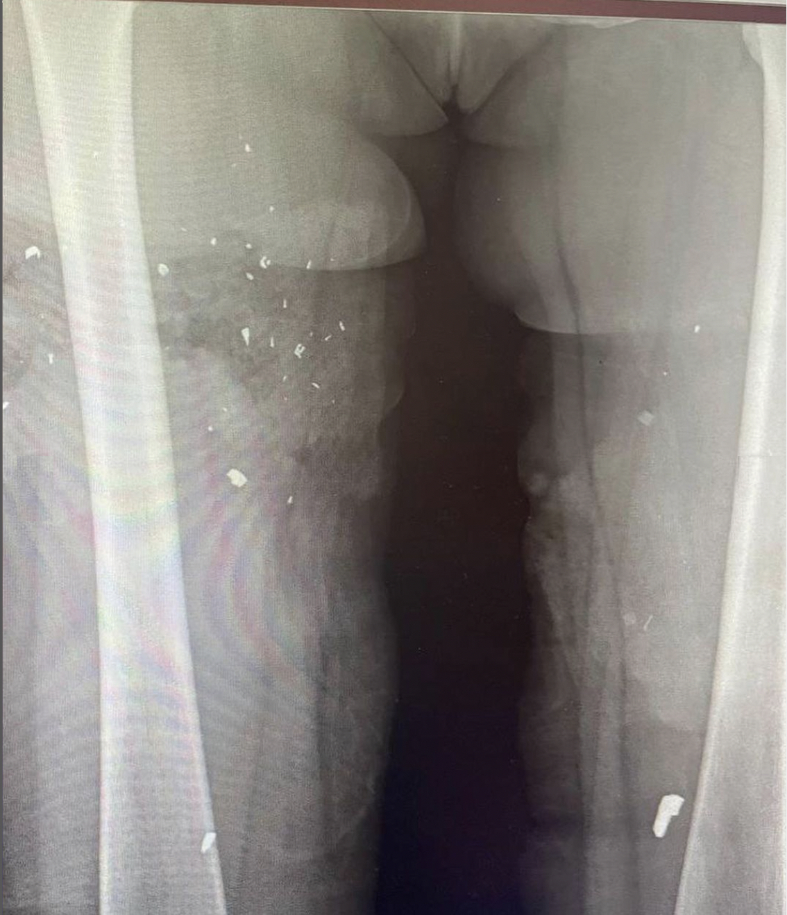 PHOTO GALLERY: Radiology images of Ukrainian trauma patients wounded in war