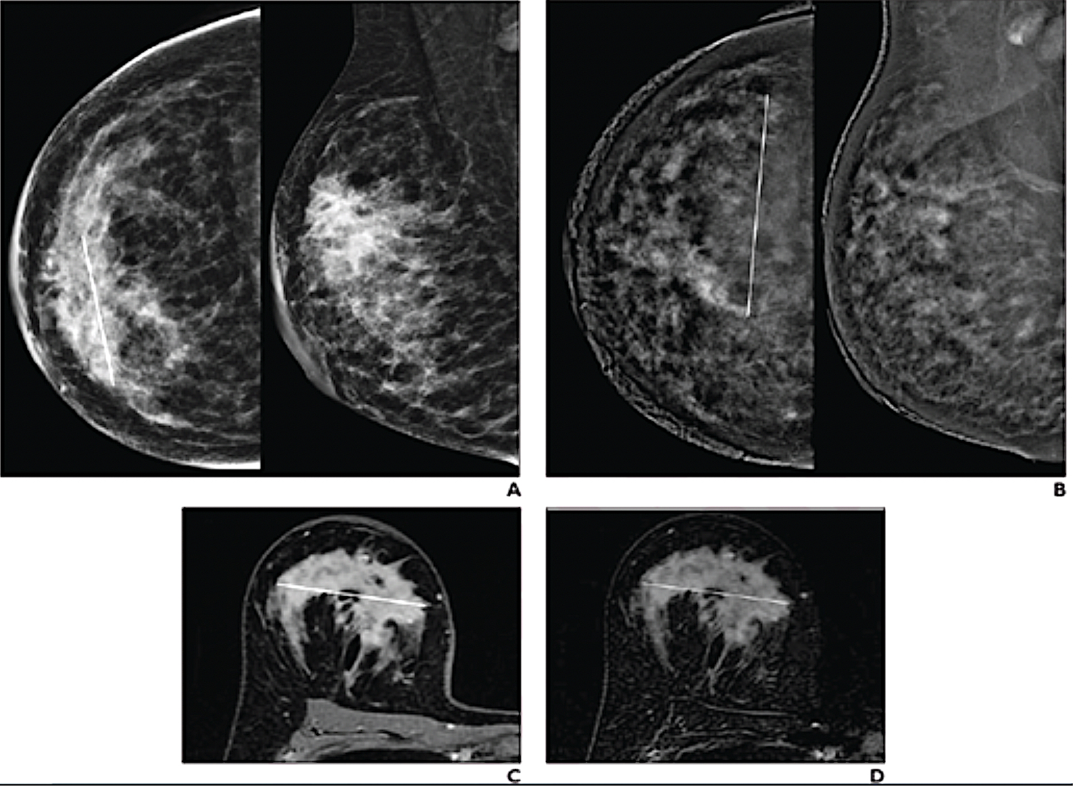 PHOTO GALLERY: What does breast cancer look like on mammography