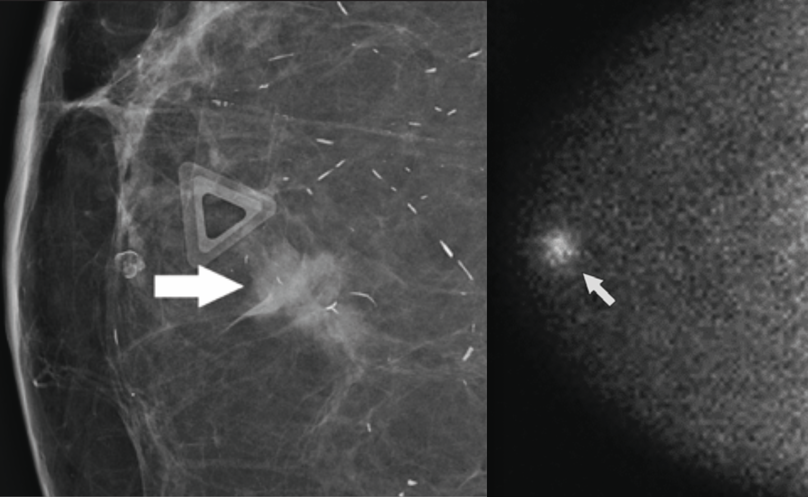 PHOTO GALLERY: What does breast cancer look like on mammography