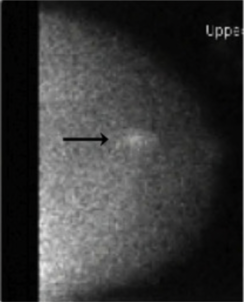 PHOTO GALLERY: What does breast cancer look like on mammography
