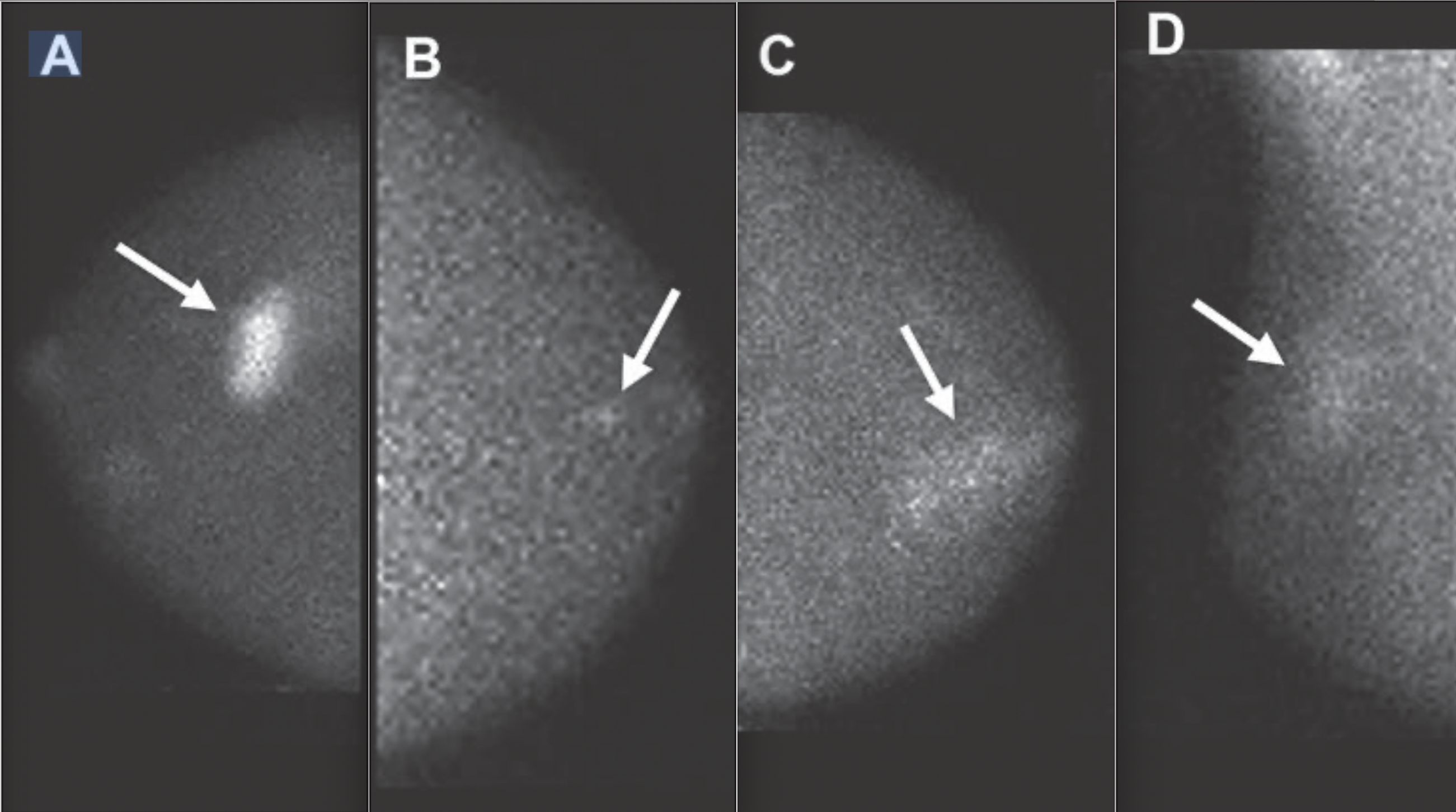 PHOTO GALLERY: What does breast cancer look like on mammography