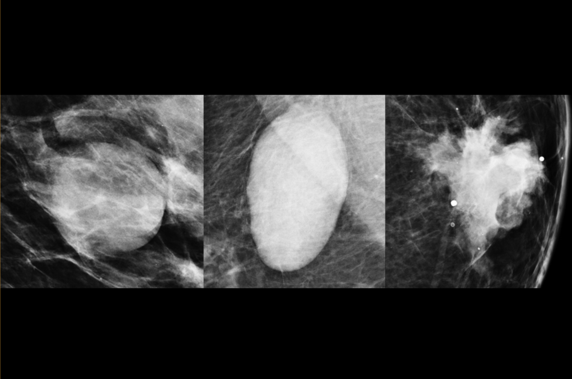 PHOTO GALLERY: What does breast cancer look like on mammography