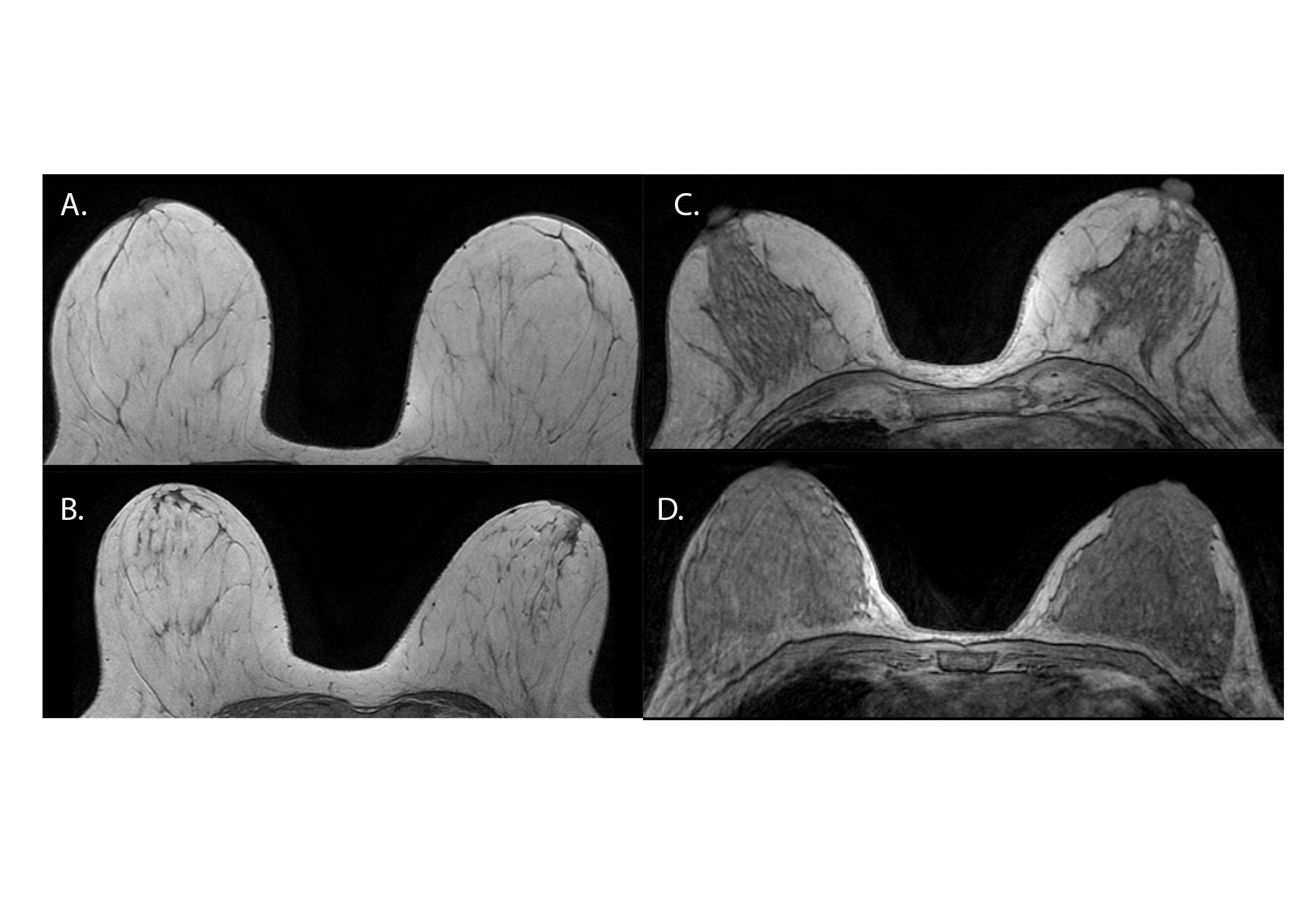 PHOTO GALLERY: What does breast cancer look like on mammography