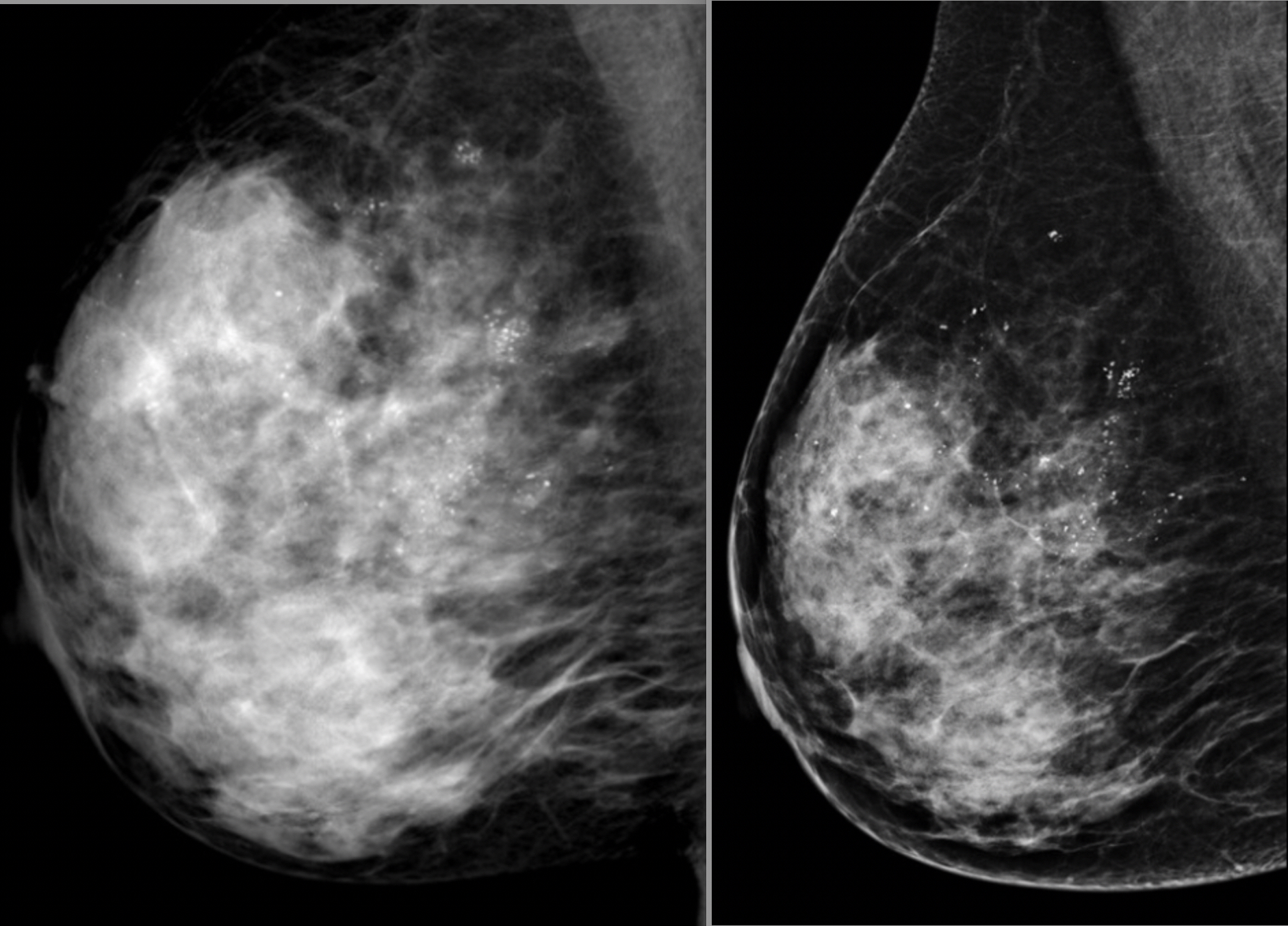 PHOTO GALLERY: What does breast cancer look like on mammography