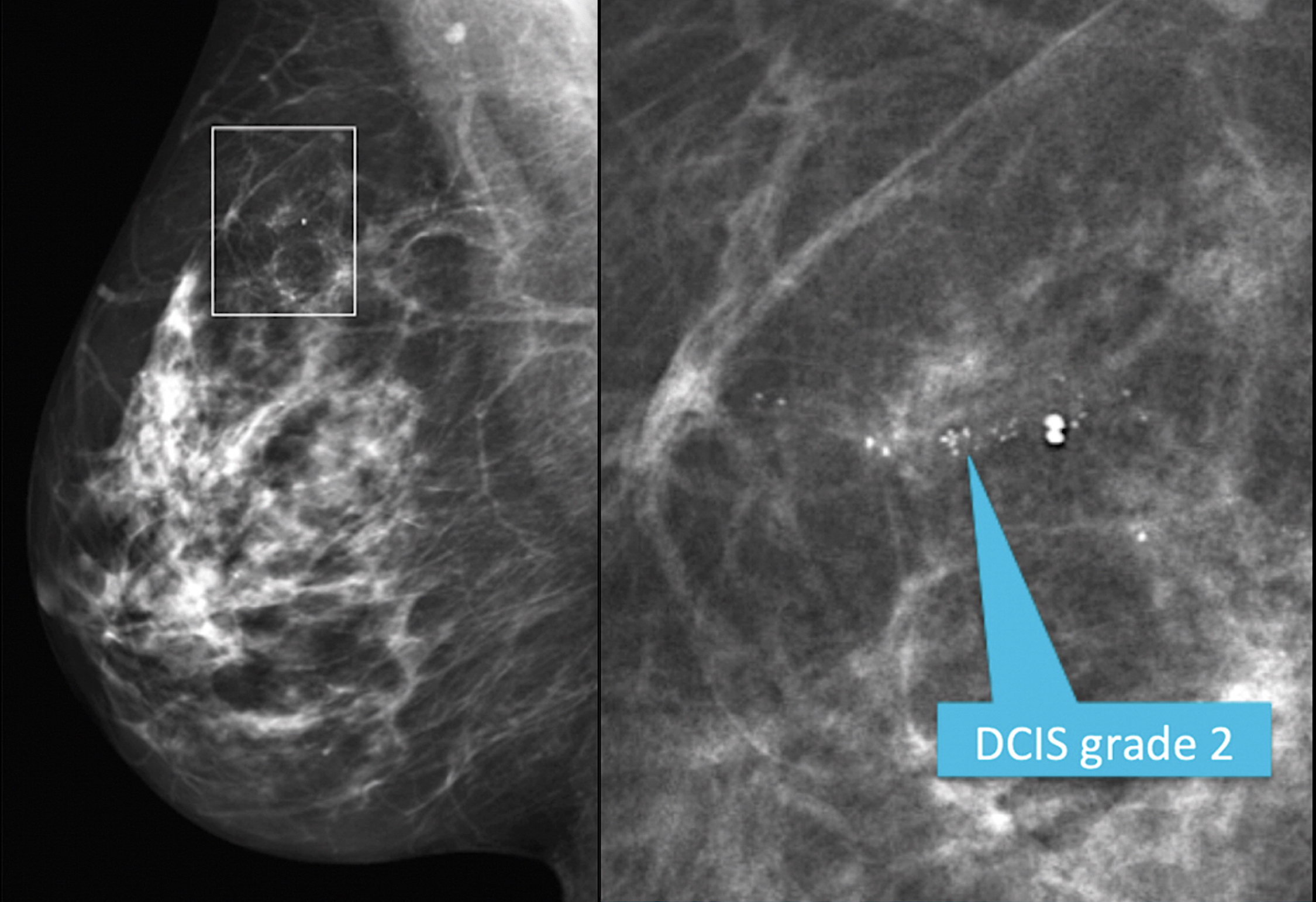 PHOTO GALLERY: What does breast cancer look like on mammography