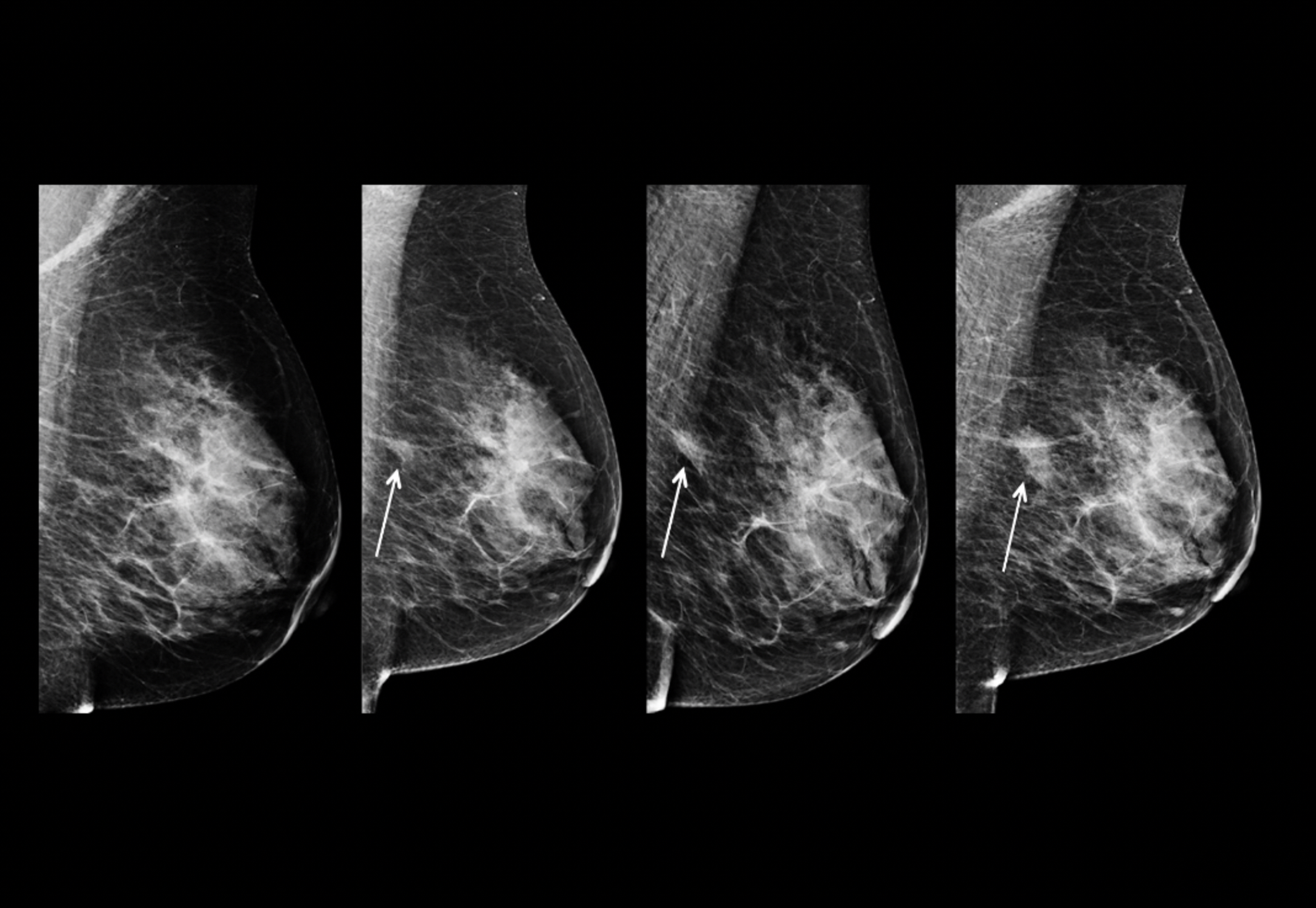 PHOTO GALLERY: What does breast cancer look like on mammography