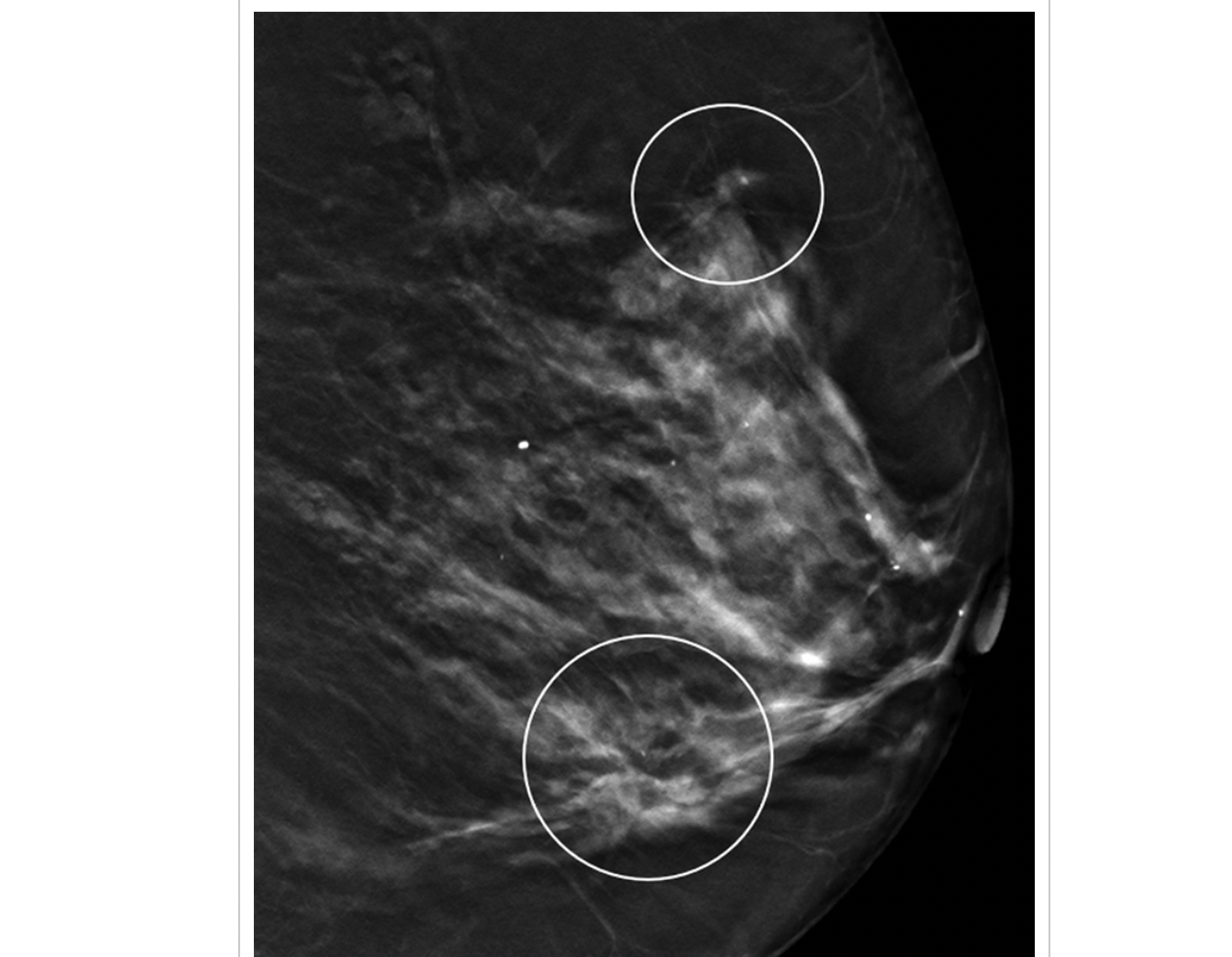 PHOTO GALLERY: What does breast cancer look like on mammography