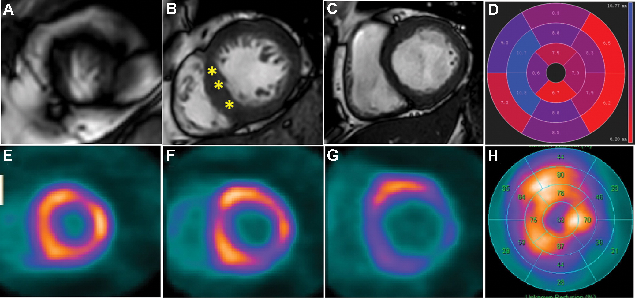 FAPI PET/CT findings linked with risk of sudden cardiac death