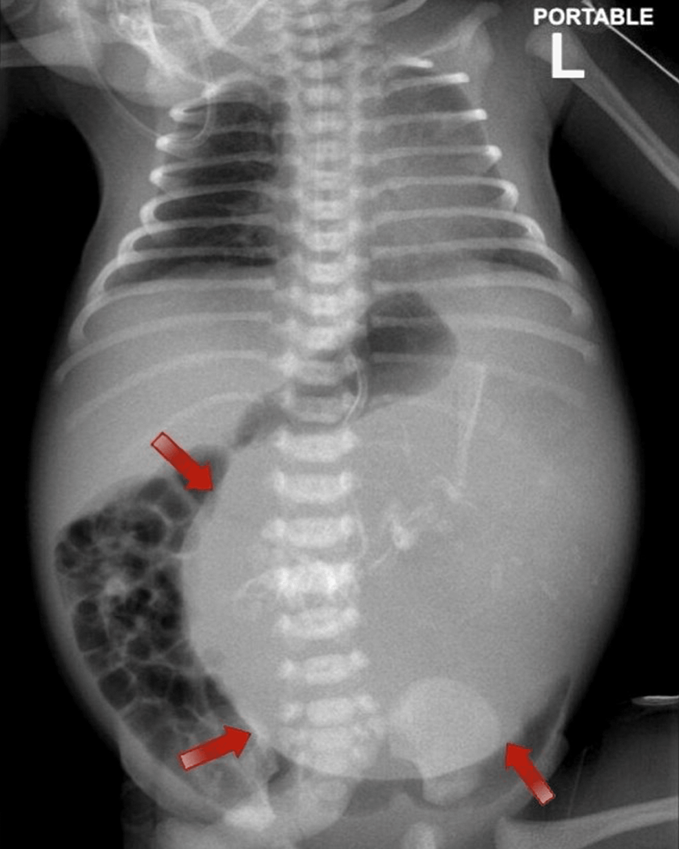 Triplet pregnancy fetus in fetu: A rare case report