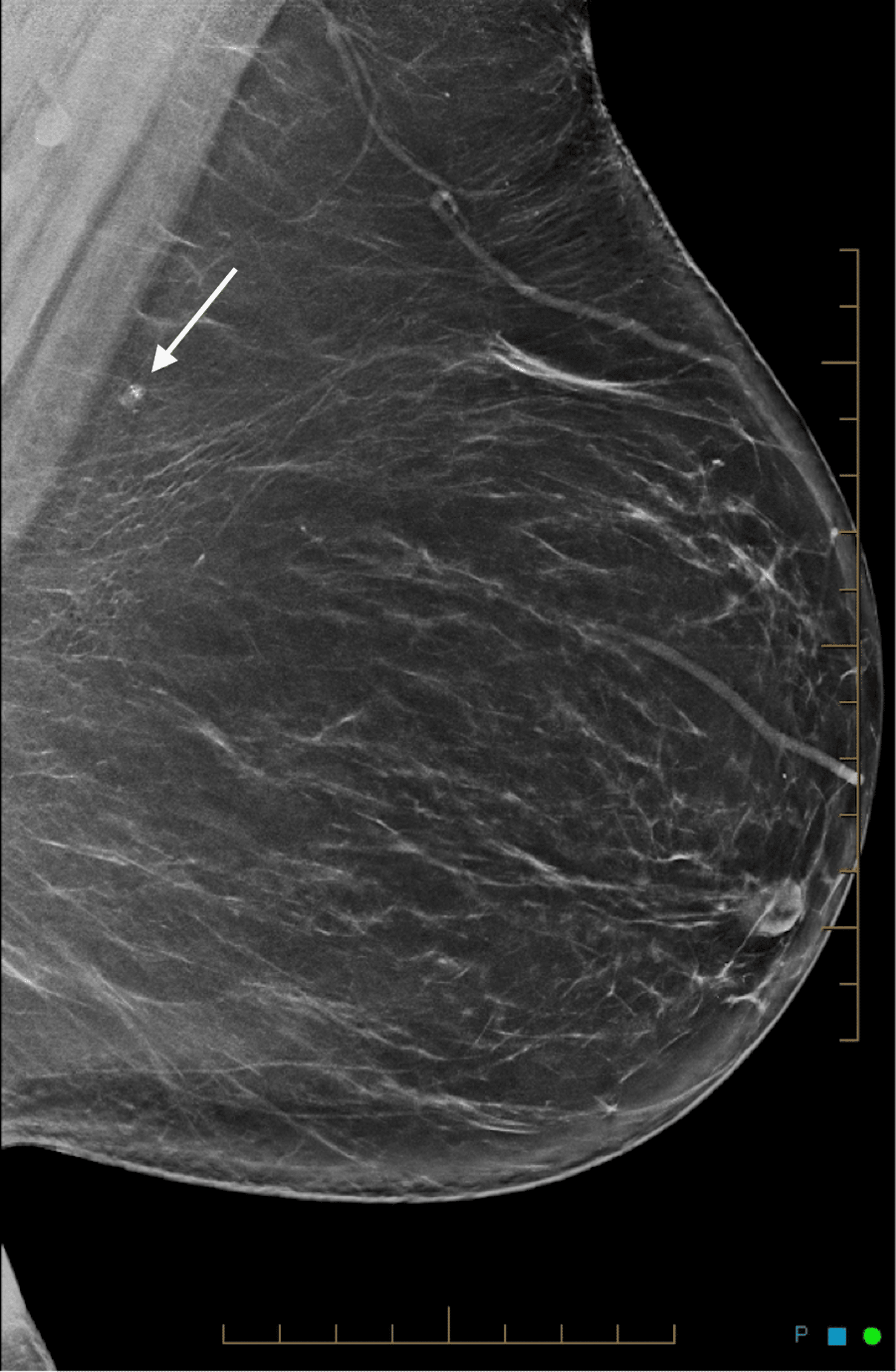 Tattoo ink can mimic breast cancer on mammography exams