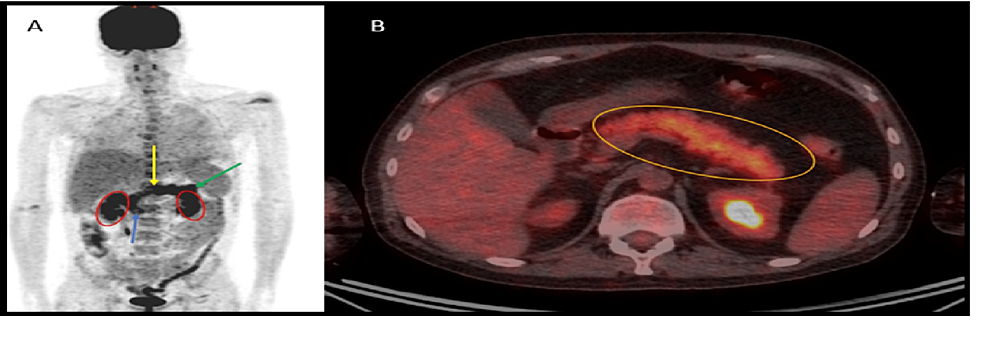 FDG PET/CT spots COVID-induced pancreatitis