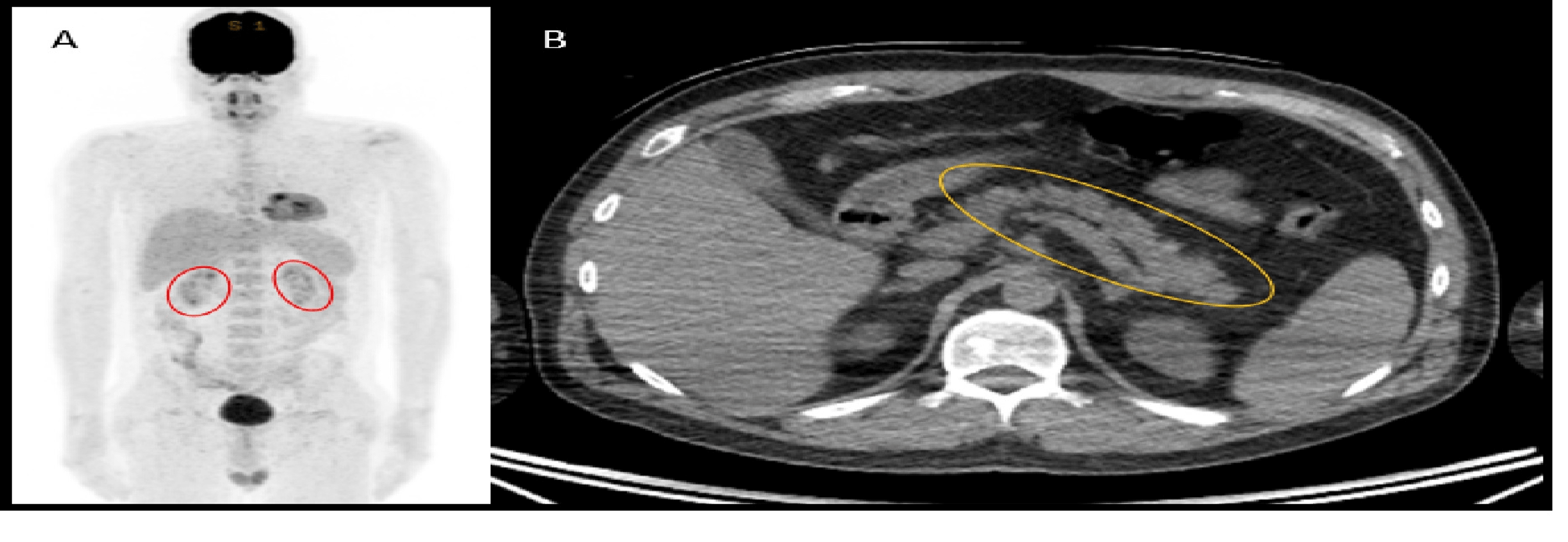 FDG PET/CT spots COVID-induced pancreatitis