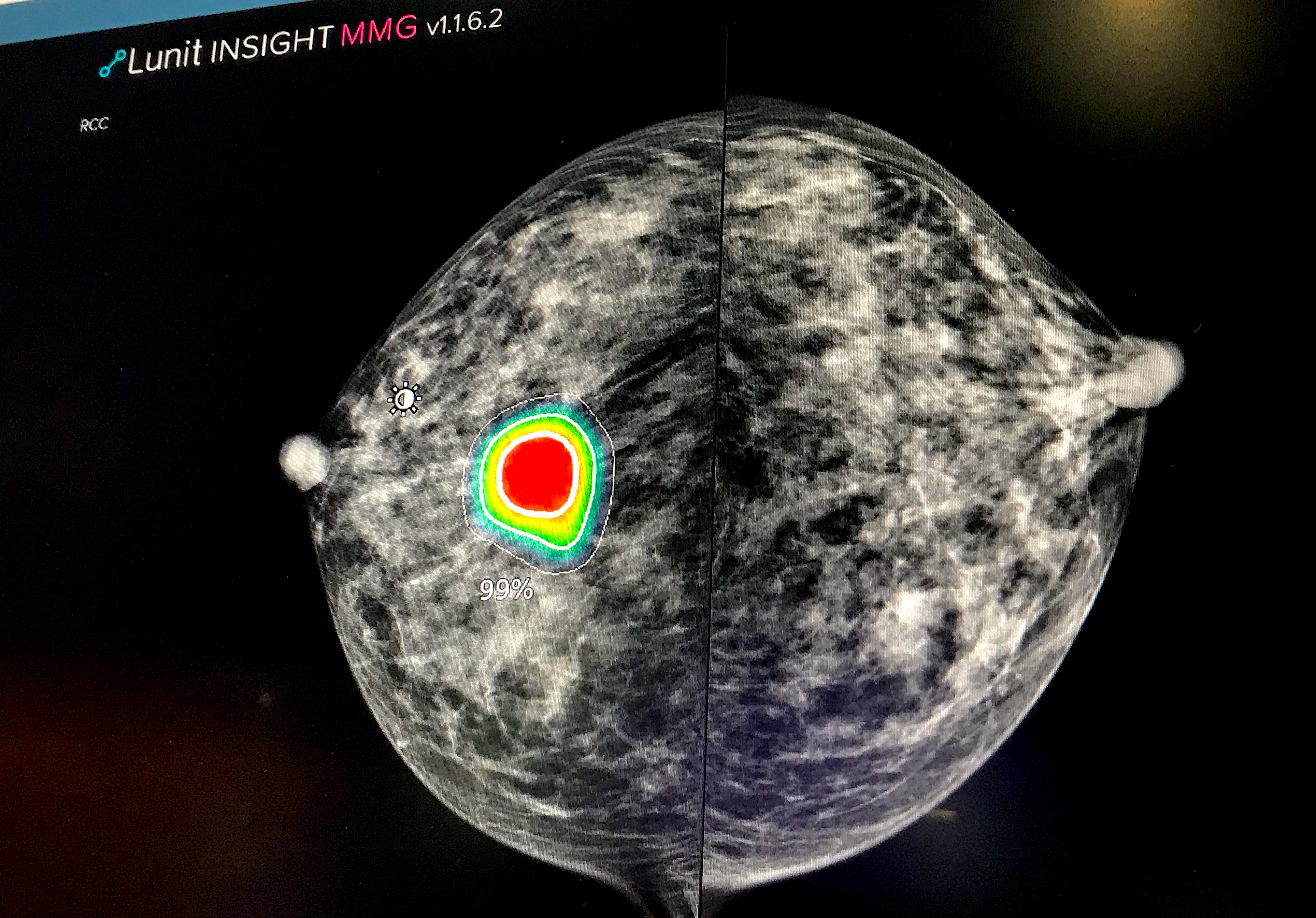 4 key trends in breast imaging