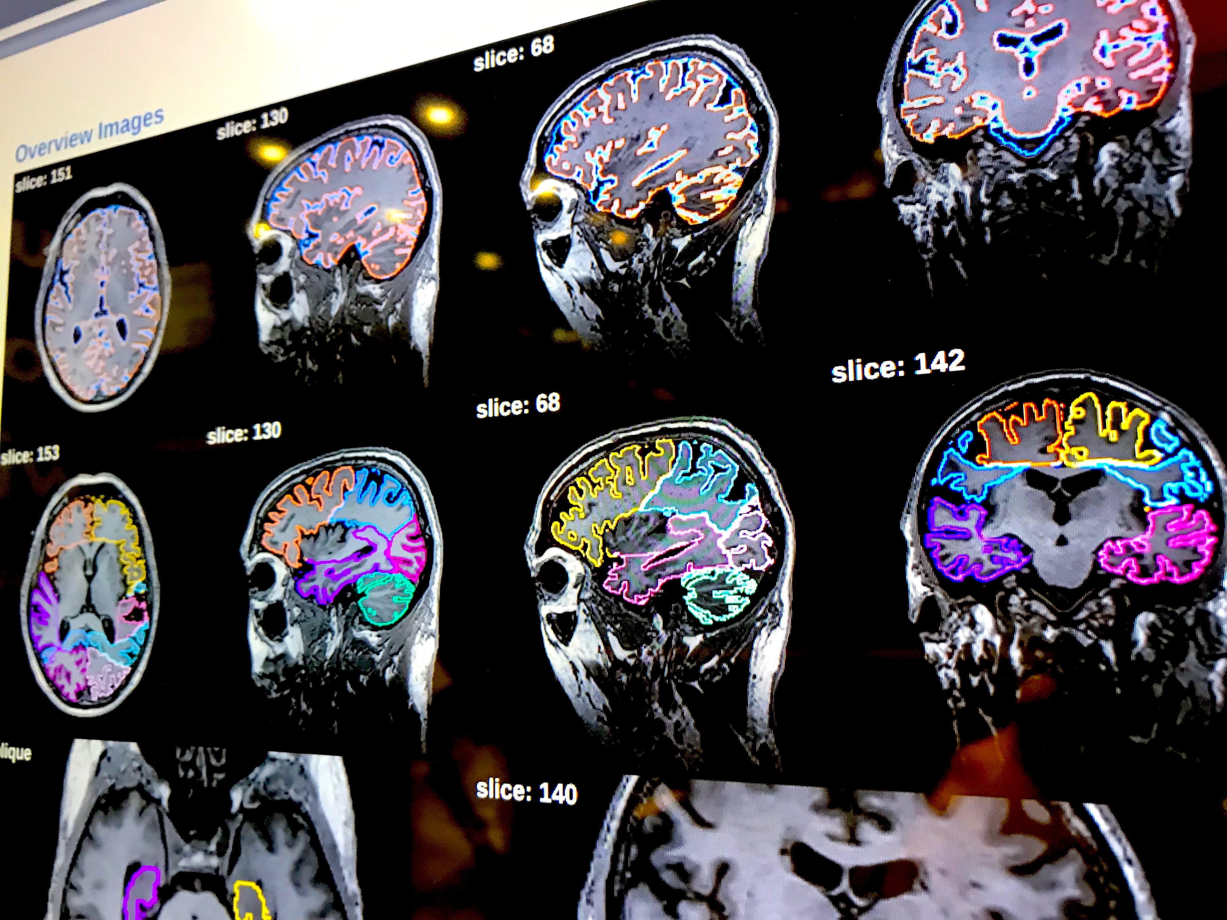 PHOTO GALLERY: Examples of FDA-cleared AI in radiology