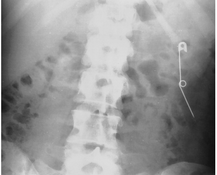 PHOTO GALLERY: Abdominal, pelvic and rectal foreign bodies