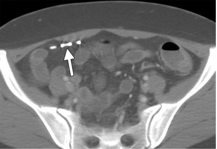 PHOTO GALLERY: Abdominal, pelvic and rectal foreign bodies