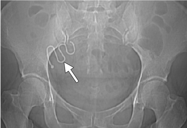 PHOTO GALLERY: Abdominal, pelvic and rectal foreign bodies