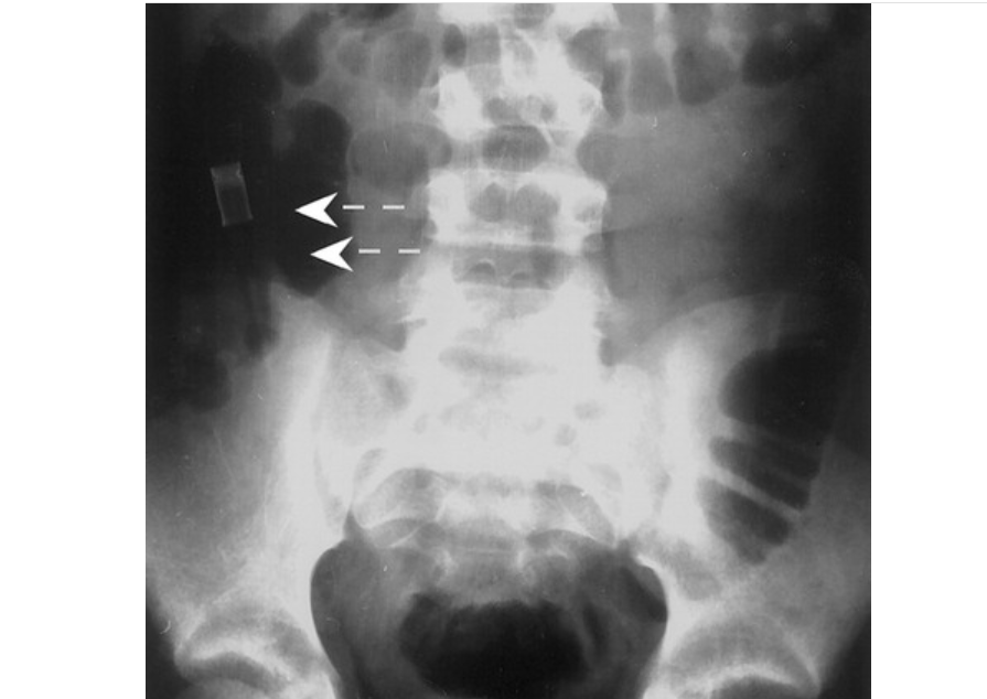 PHOTO GALLERY: Abdominal, pelvic and rectal foreign bodies