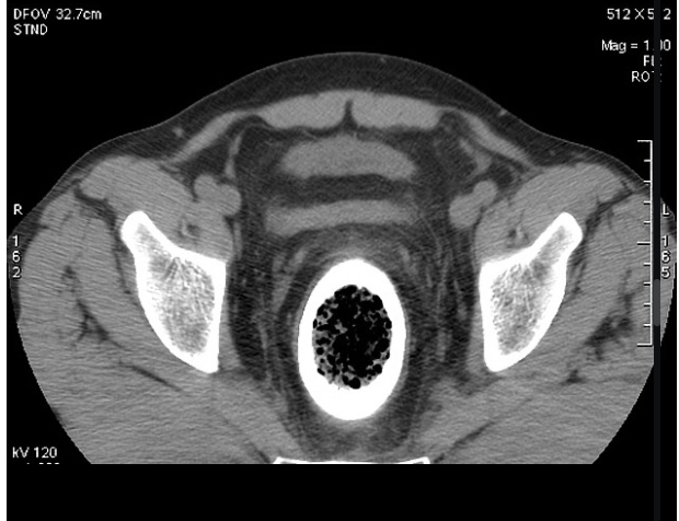PHOTO GALLERY: Abdominal, pelvic and rectal foreign bodies