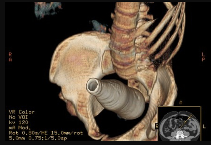 PHOTO GALLERY: Abdominal, pelvic and rectal foreign bodies