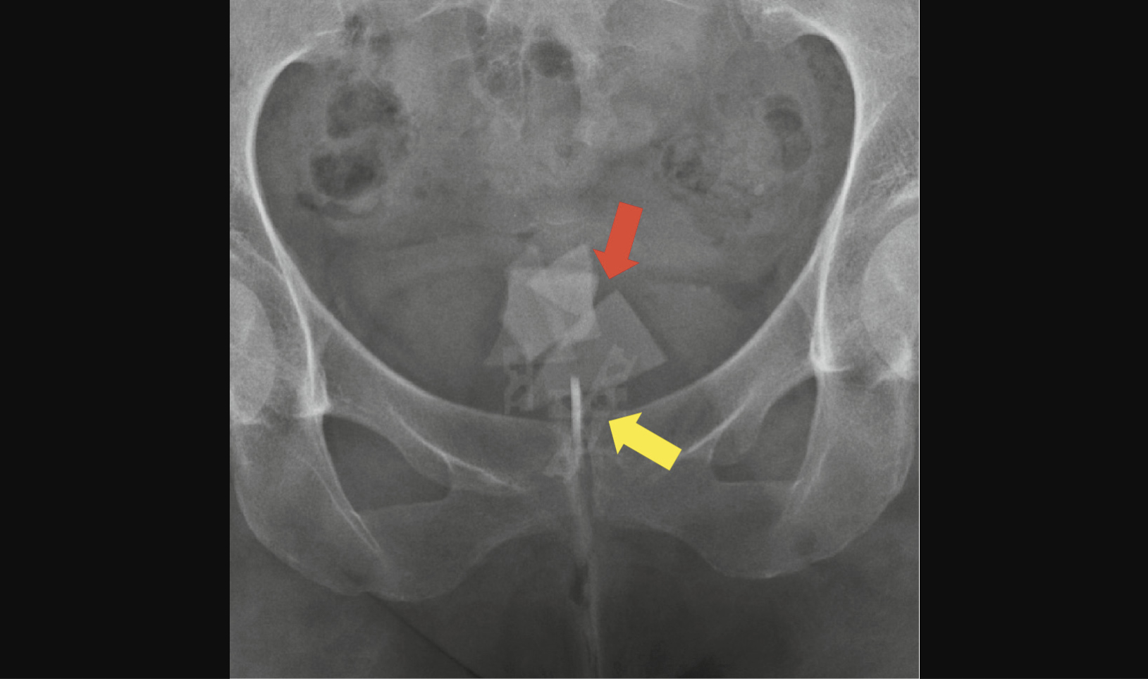 PHOTO GALLERY: Abdominal, pelvic and rectal foreign bodies