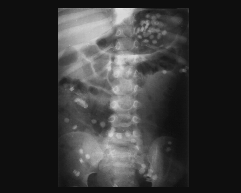 PHOTO GALLERY: Abdominal, pelvic and rectal foreign bodies