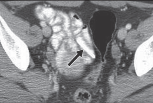 PHOTO GALLERY: Abdominal, pelvic and rectal foreign bodies