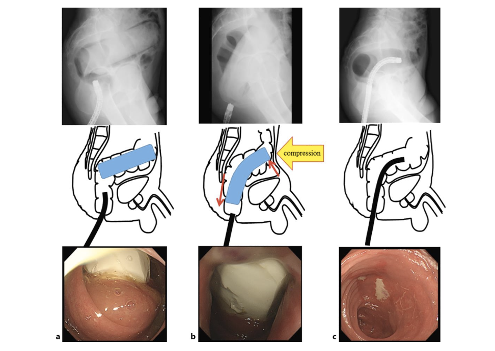 PHOTO GALLERY: Abdominal, pelvic and rectal foreign bodies