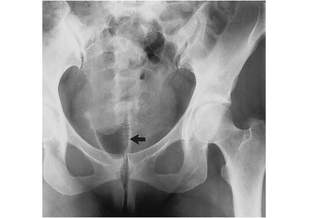 PHOTO GALLERY: Abdominal, pelvic and rectal foreign bodies