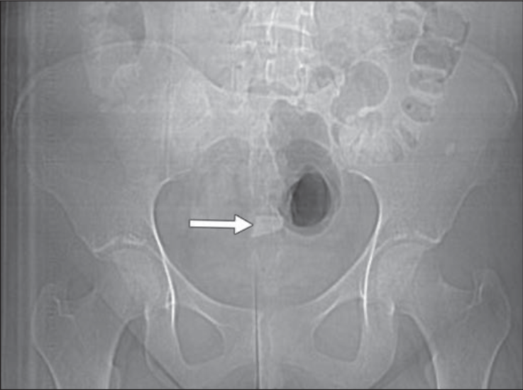 PHOTO GALLERY: Abdominal, pelvic and rectal foreign bodies