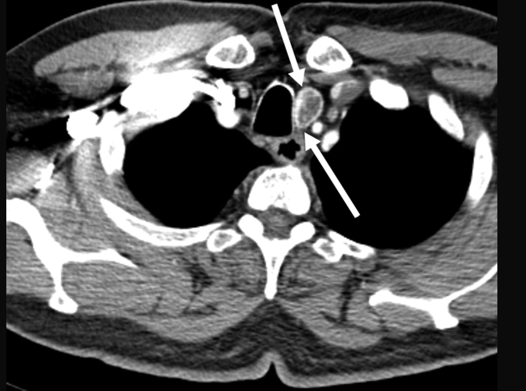 PHOTO GALLERY: What do thyroid nodules look like on imaging