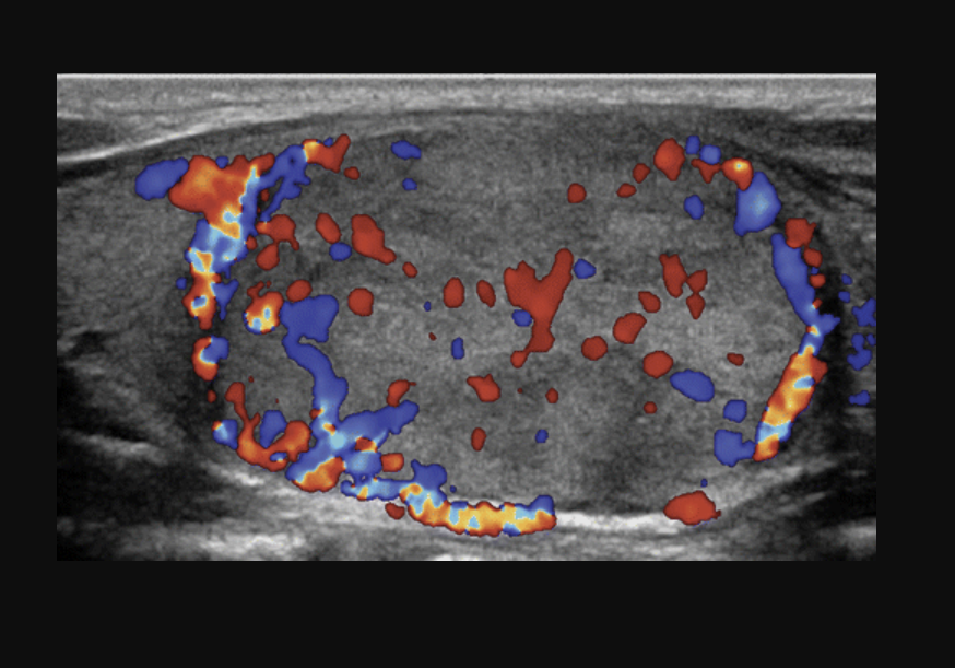 PHOTO GALLERY: What do thyroid nodules look like on imaging