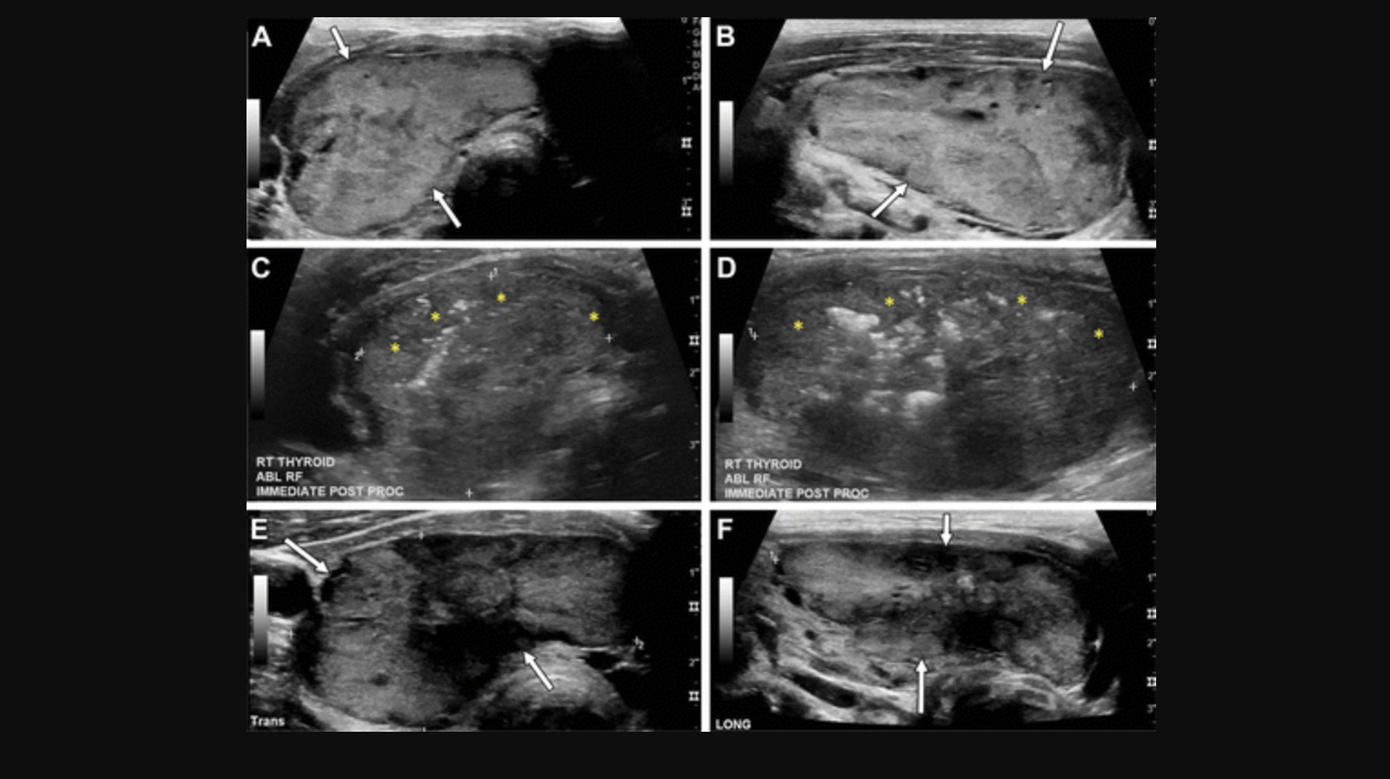 PHOTO GALLERY: What do thyroid nodules look like on imaging