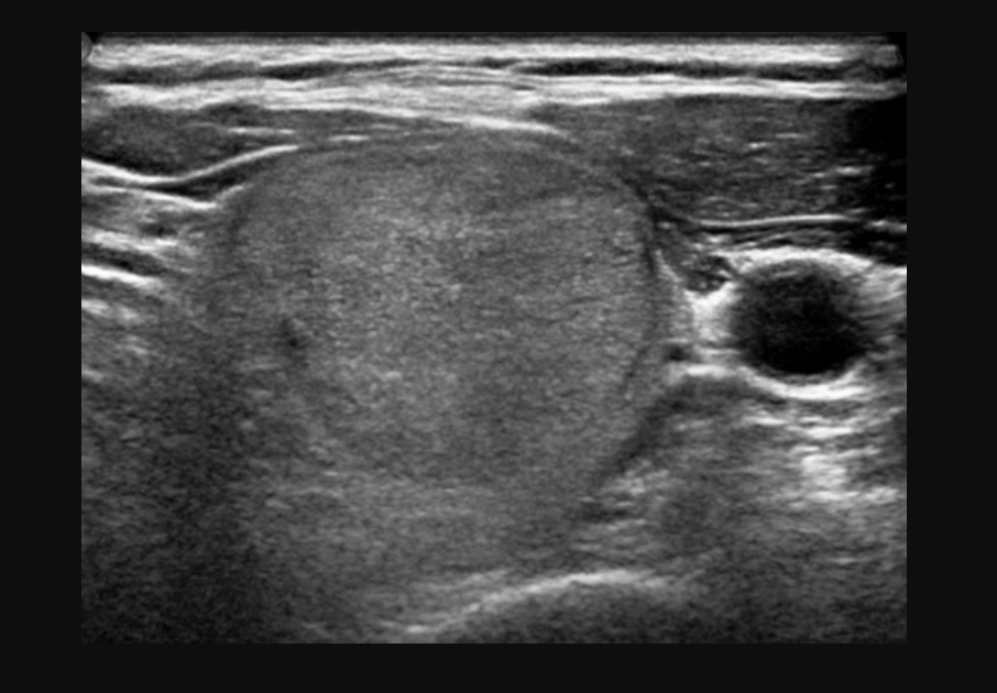 PHOTO GALLERY: What do thyroid nodules look like on imaging