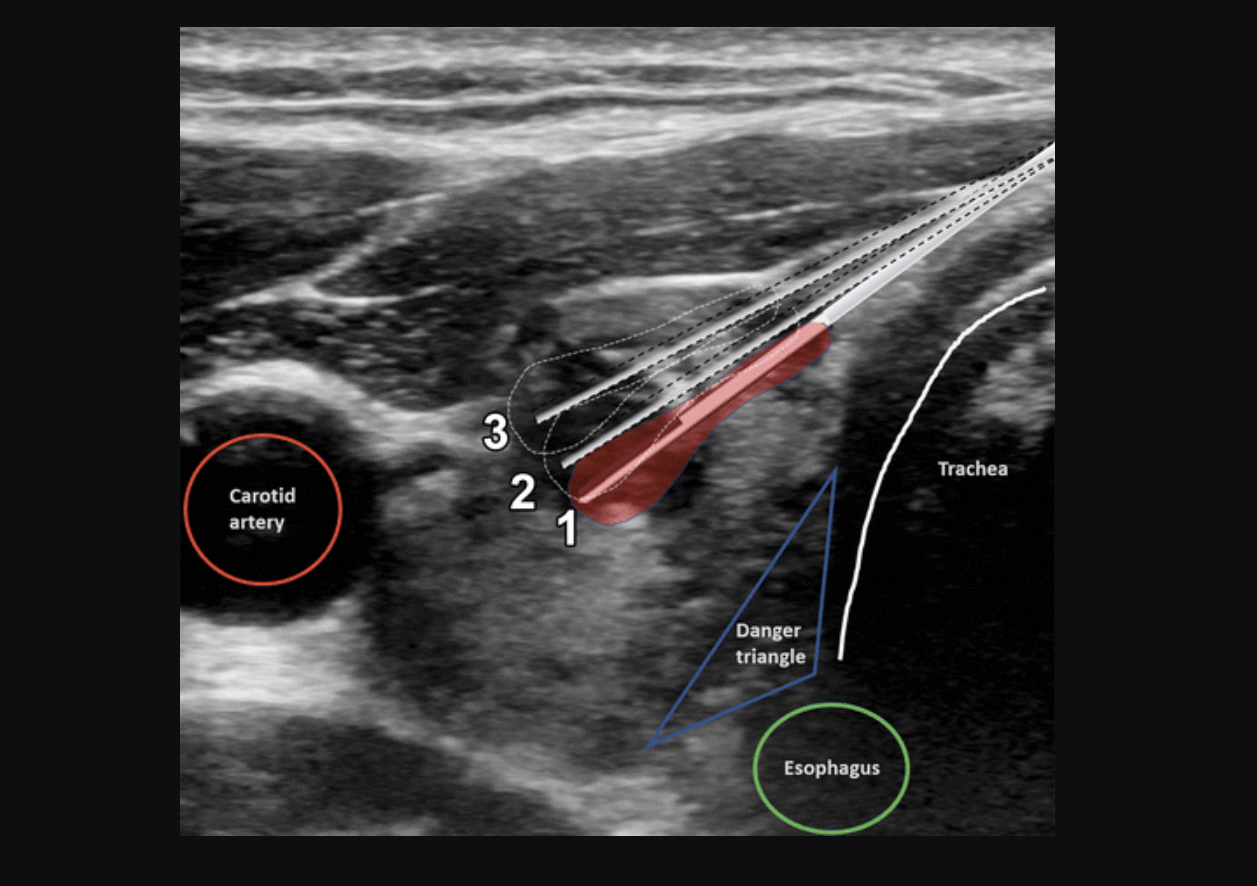 Thyroid Lesions Thyroid Nodules | Johns Hopkins Medicine
