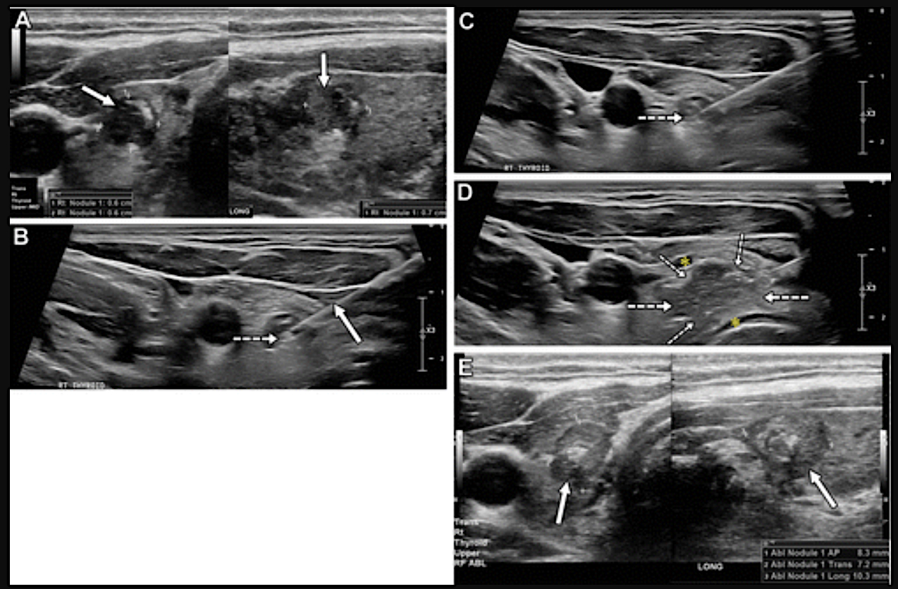 PHOTO GALLERY: What do thyroid nodules look like on imaging