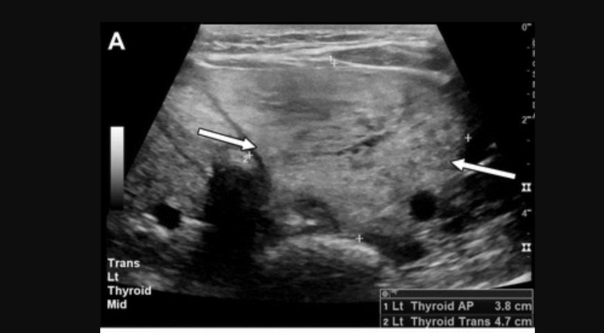 PHOTO GALLERY: What do thyroid nodules look like on imaging
