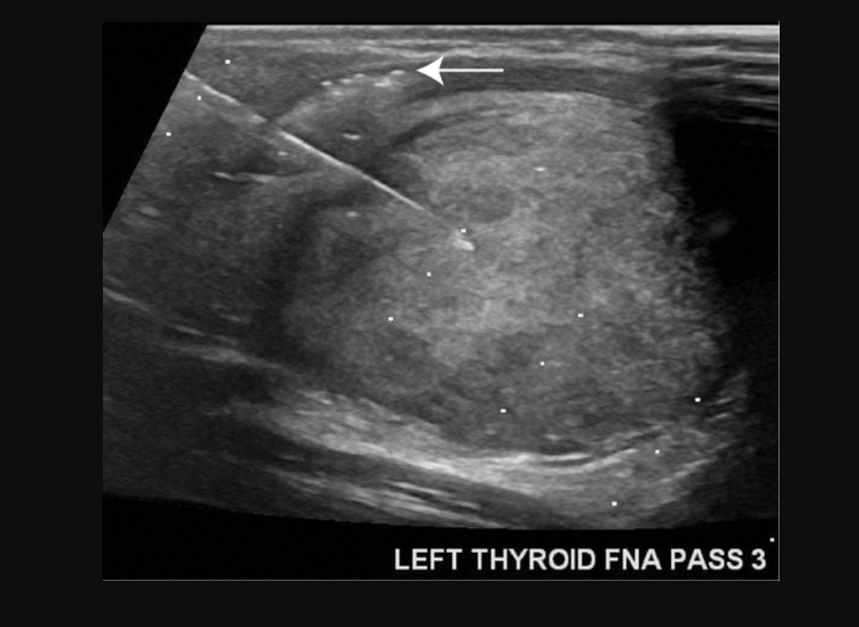 PHOTO GALLERY: What do thyroid nodules look like on imaging