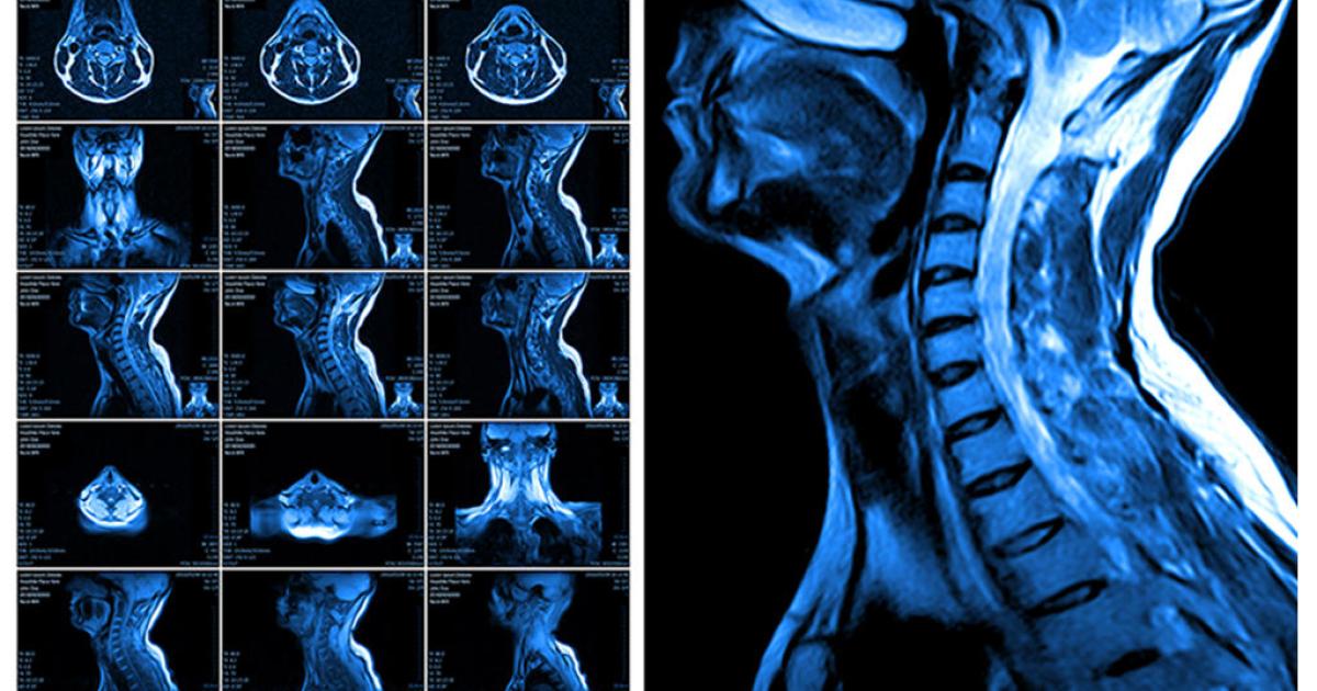 Neck injury follow-up MRI may cost patients thousands in unnecessary exams