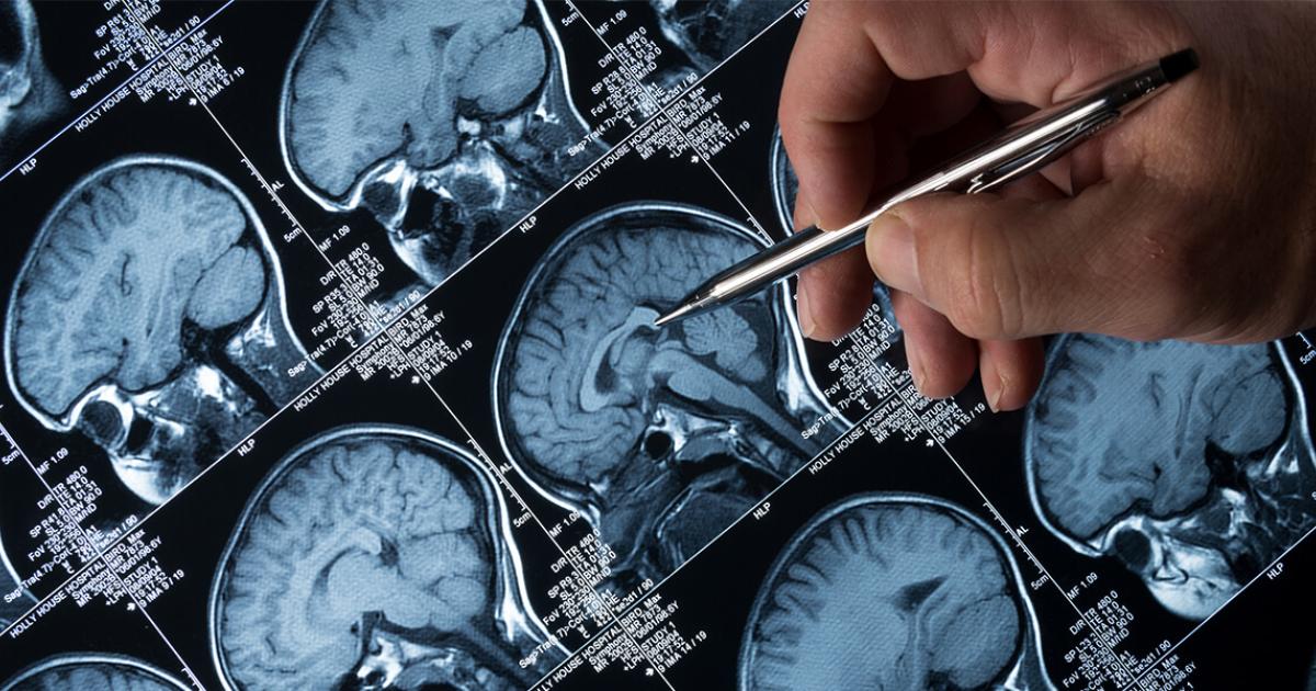 3D imaging, temperature map allow physicians to see ablation of brain ...