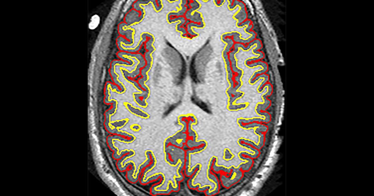 MRI shows ibudilast drug may slow brain atrophy in MS patients