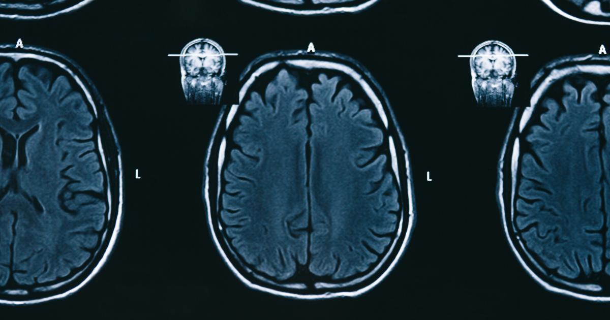 MRI scans connect head injury microbleeds to poor outcomes