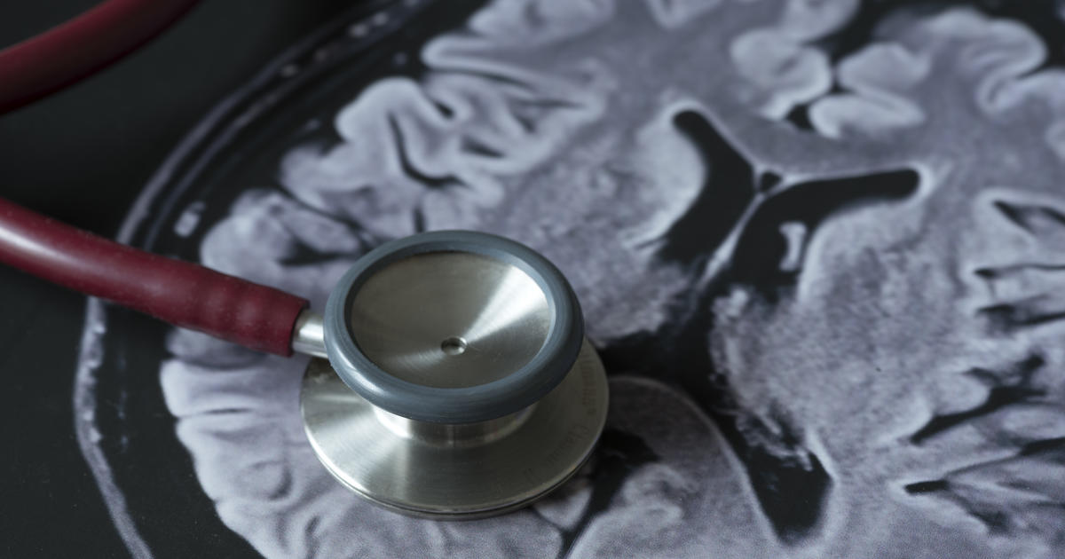 AI helps bolster radiologists’ ability to detect ADHD using MRI