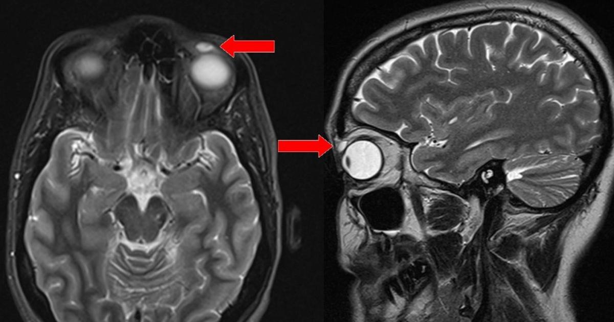 Out of sight, out of mind: MRI helps doctors find missing contact lens ...