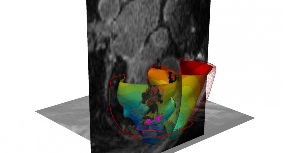 3D heart model uses MRI to pinpoint source of arrhythmia