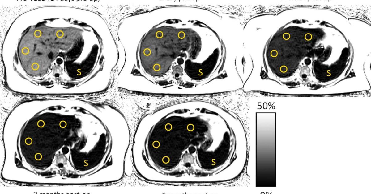 MRI improves liver fat monitoring in obese patients