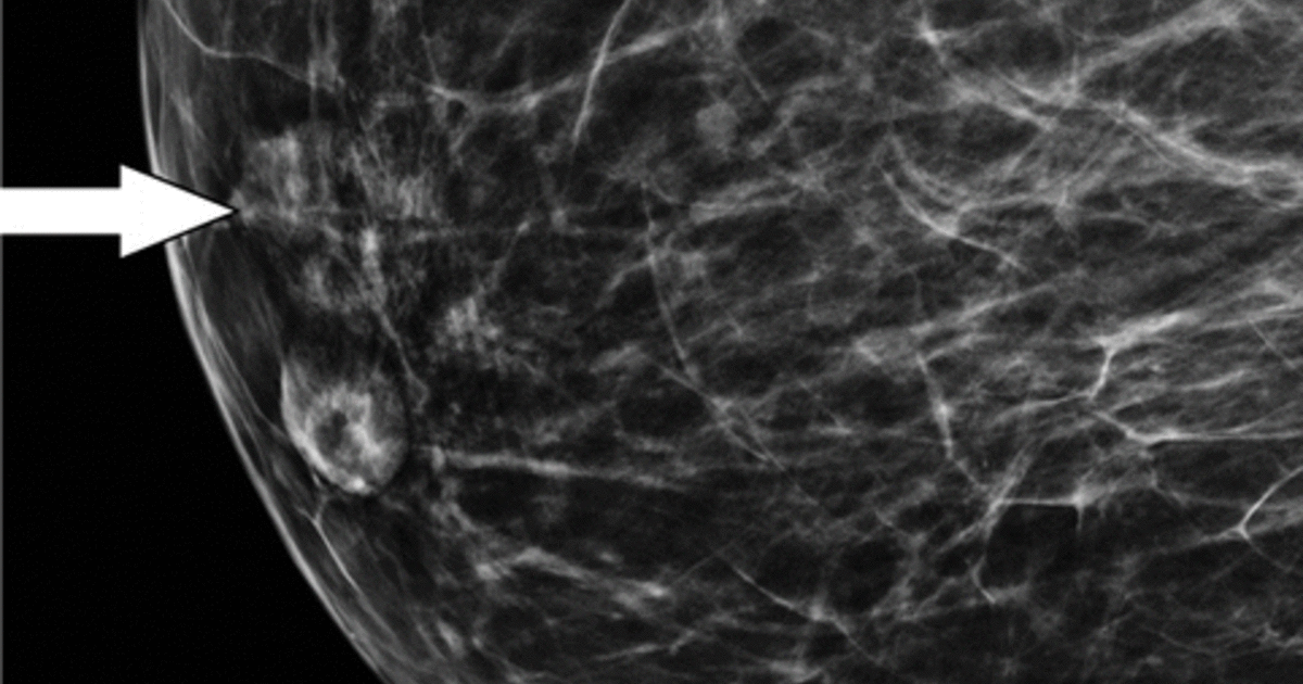 Digital mammography increases breast cancer detection by 14%