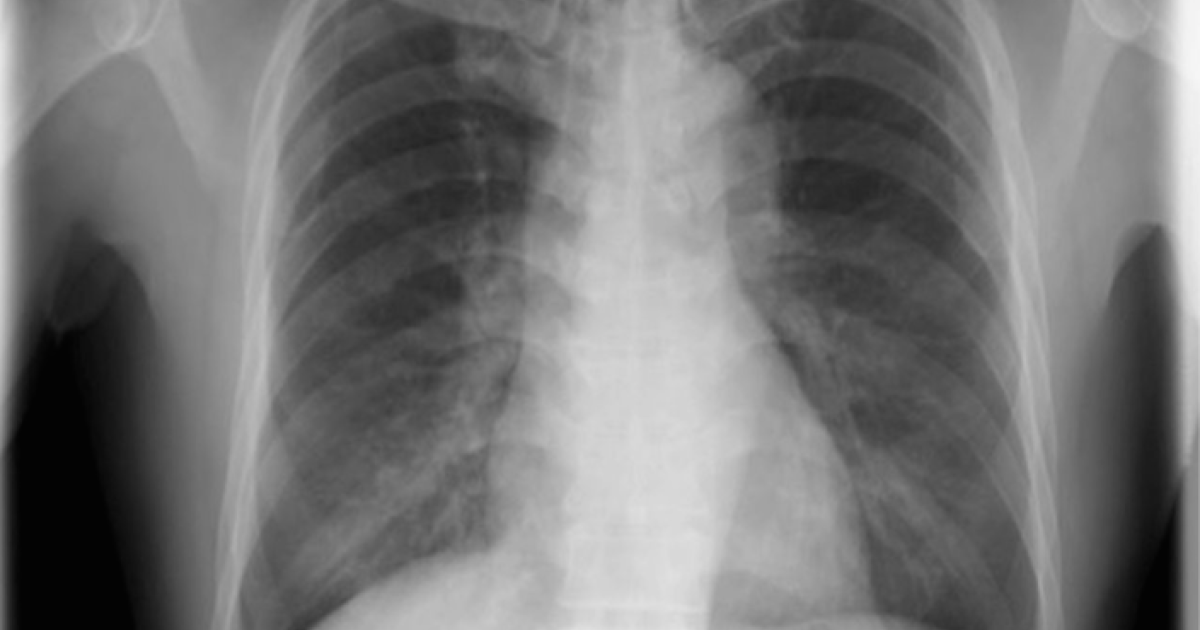 Ex-smoker's CT scan reveals rare lung cancer mimicking asthma