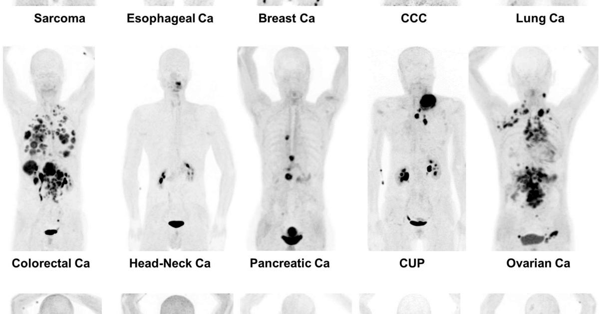 Radiotracer could help treat 28 different types of cancer