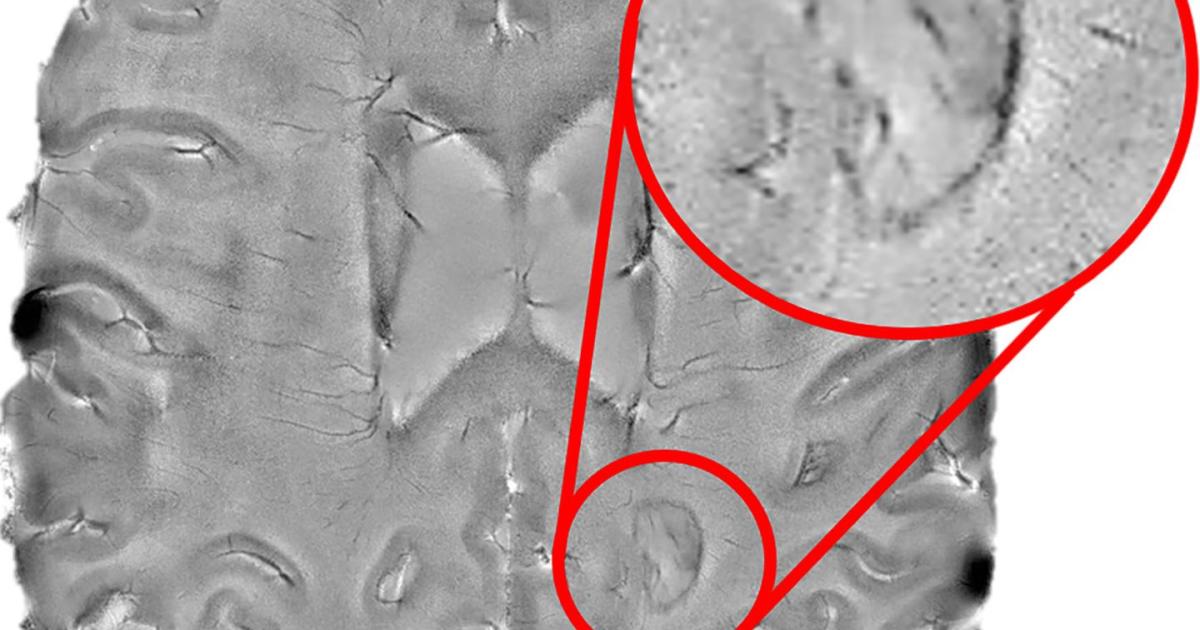 MRI reveals ‘smoldering’ brain spots may indicate severe MS